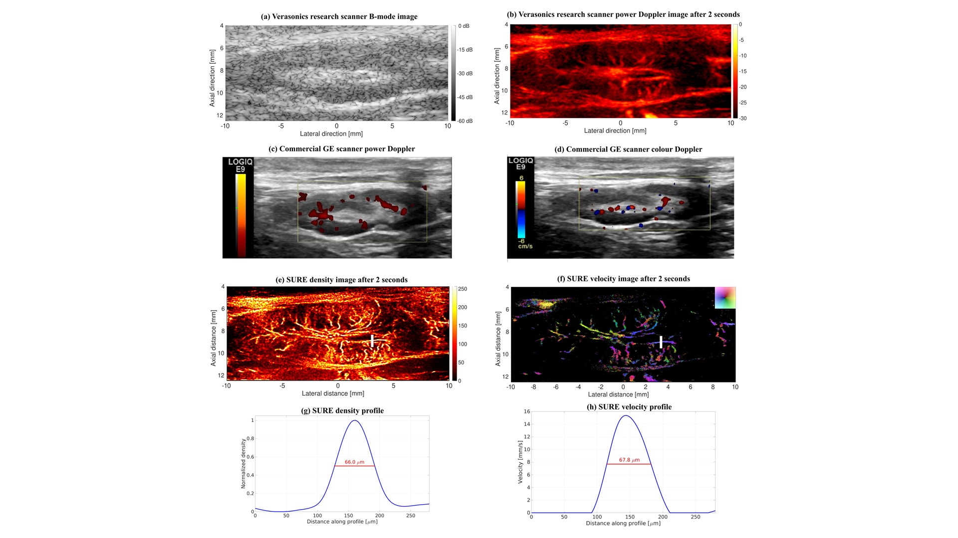 Human lymph node microvascular imaging using a fast contrast free super ...