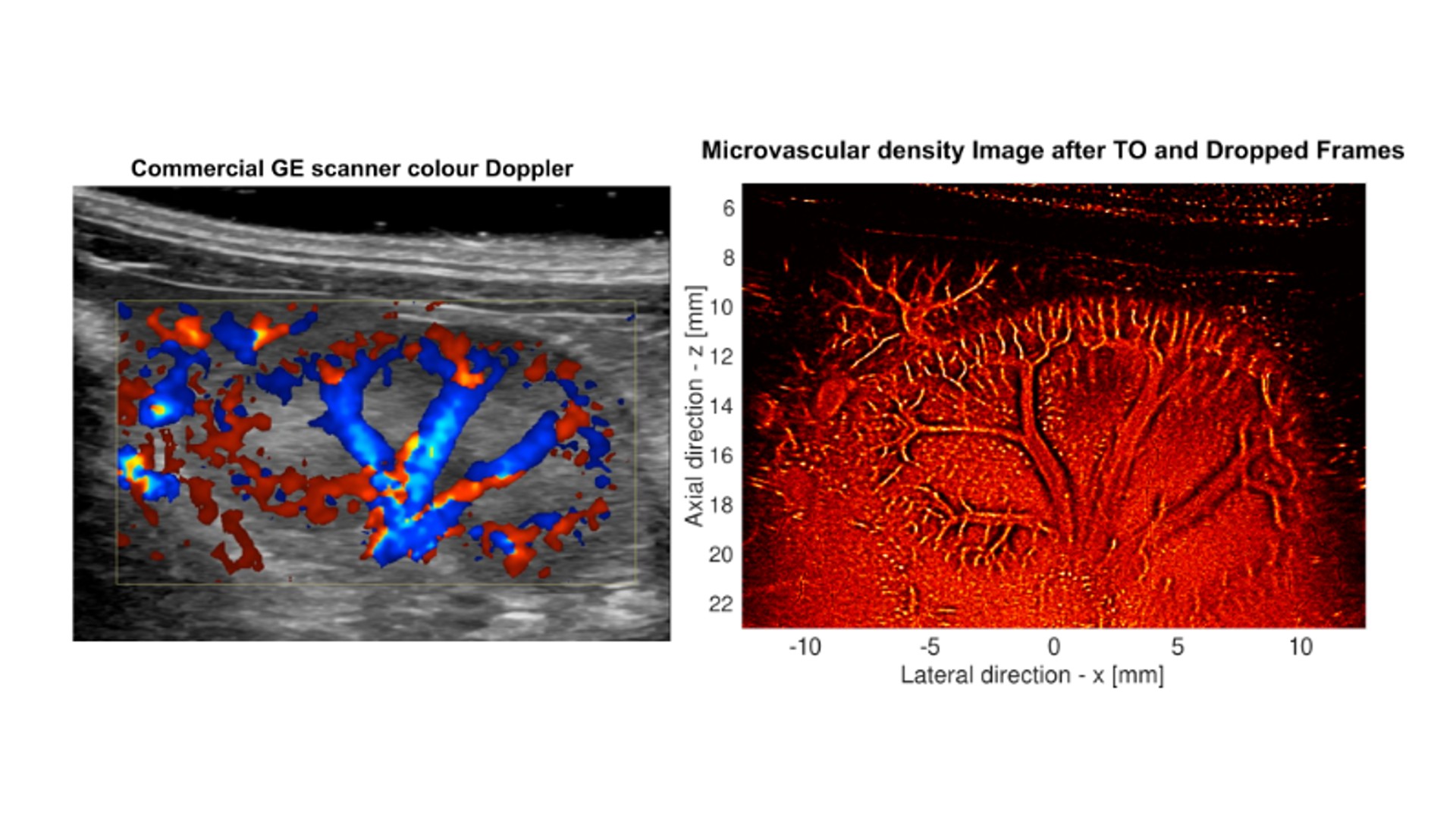 Transcutaneous Liver and Kidney Microvascular Imaging Using Dropped ...